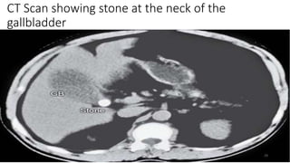 Aetiopathologenesis and management of acute cholecystitis | PDF