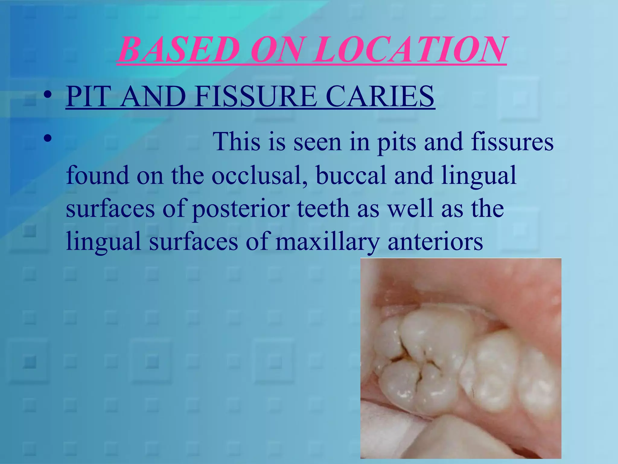 Aetiopathology & classification of caries | PPT