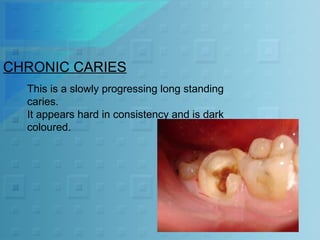 Aetiopathology & classification of caries | PPT