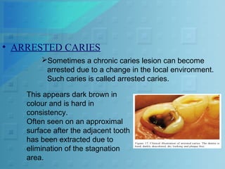 Aetiopathology & classification of caries | PPT