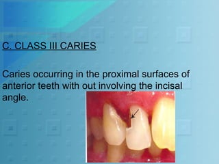 Aetiopathology & classification of caries | PPT