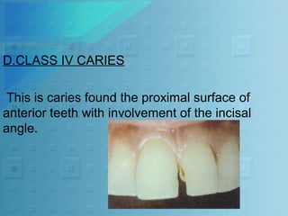 Aetiopathology & classification of caries | PPT