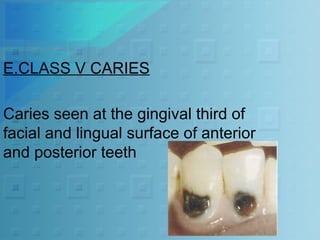 Aetiopathology & classification of caries | PPT