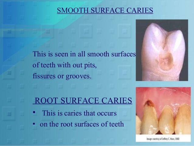 Aetiopathology & classification of caries