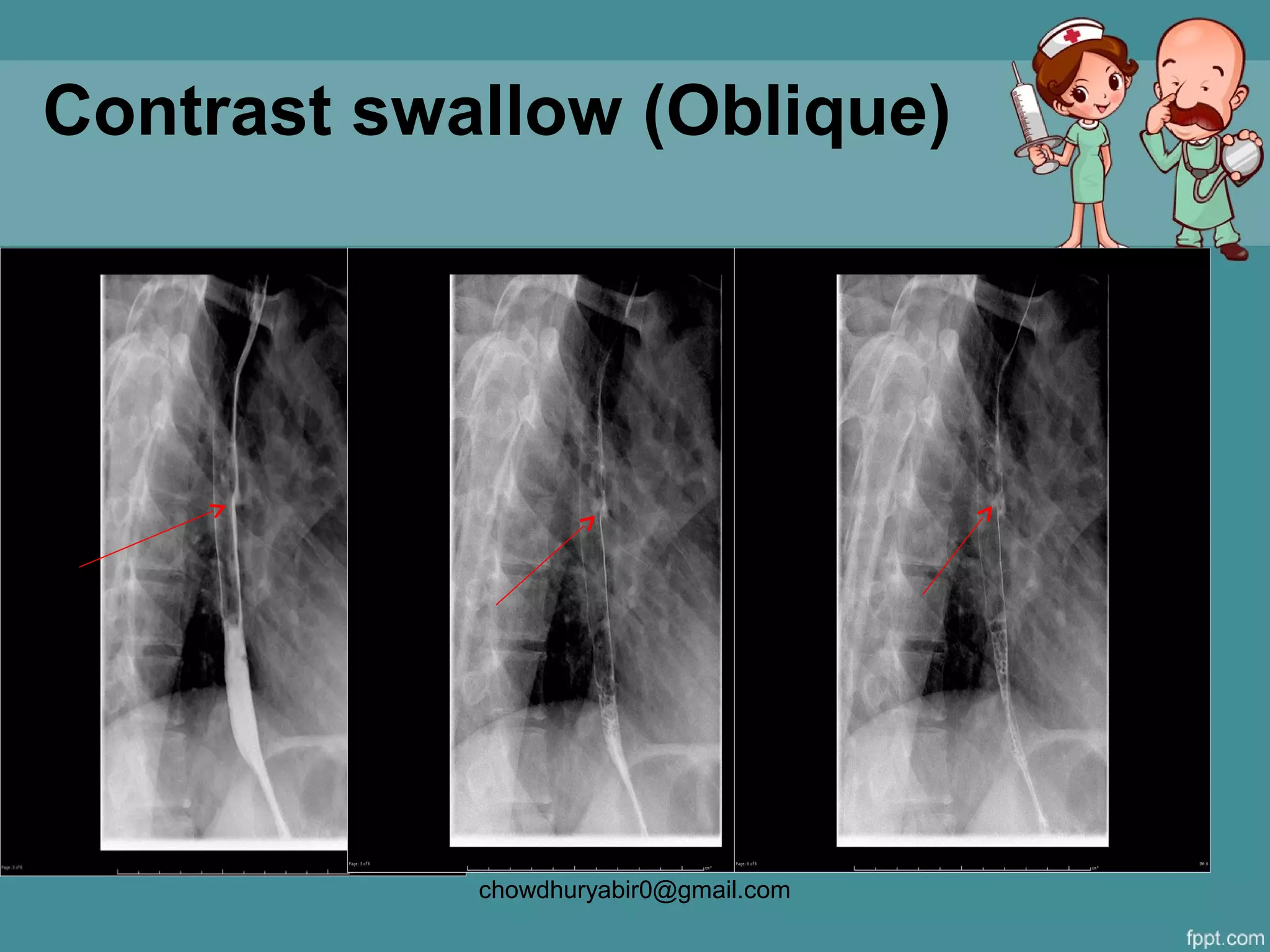 Esophageal Perforation | PPT