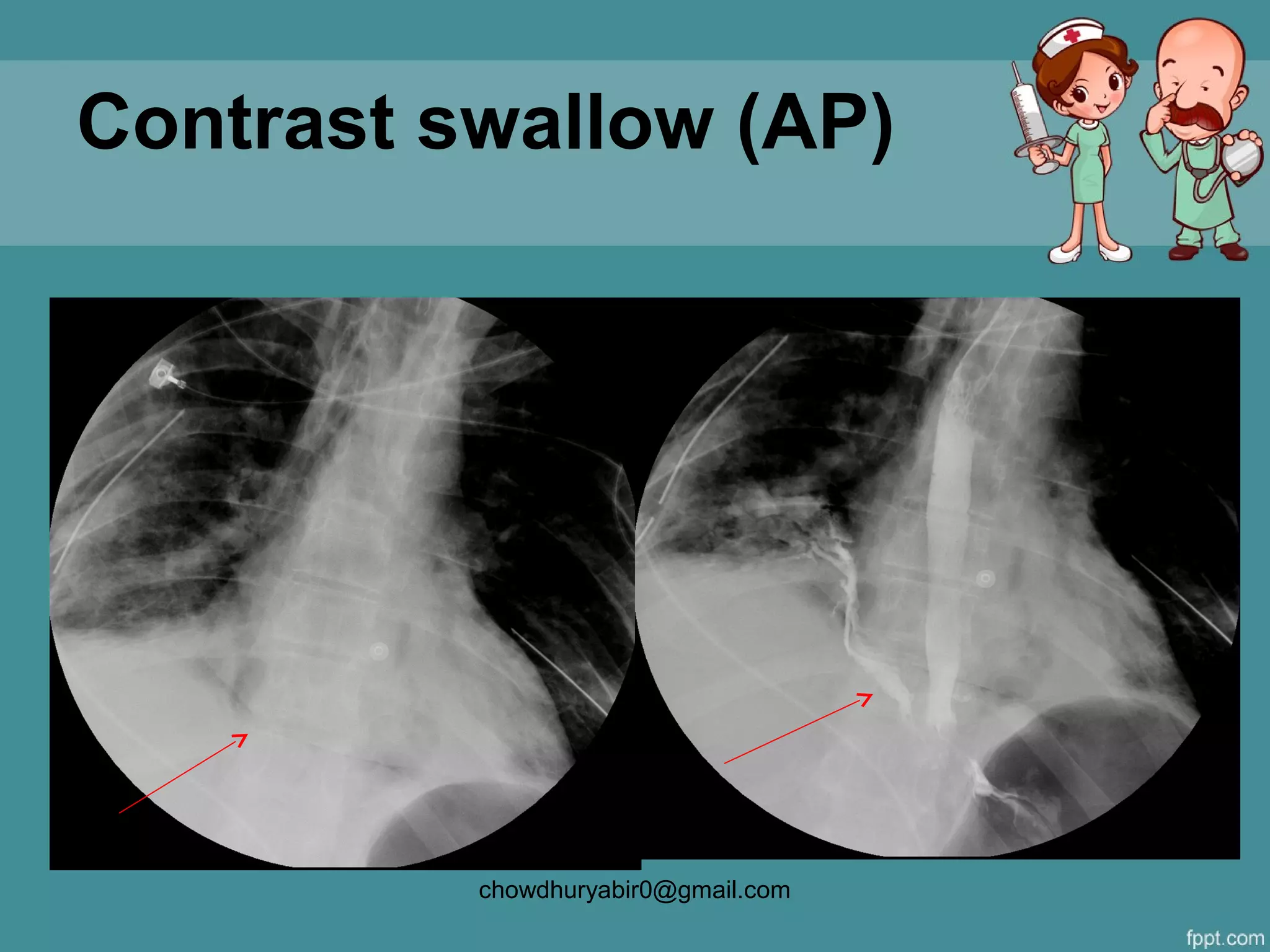 Esophageal Perforation | PPT
