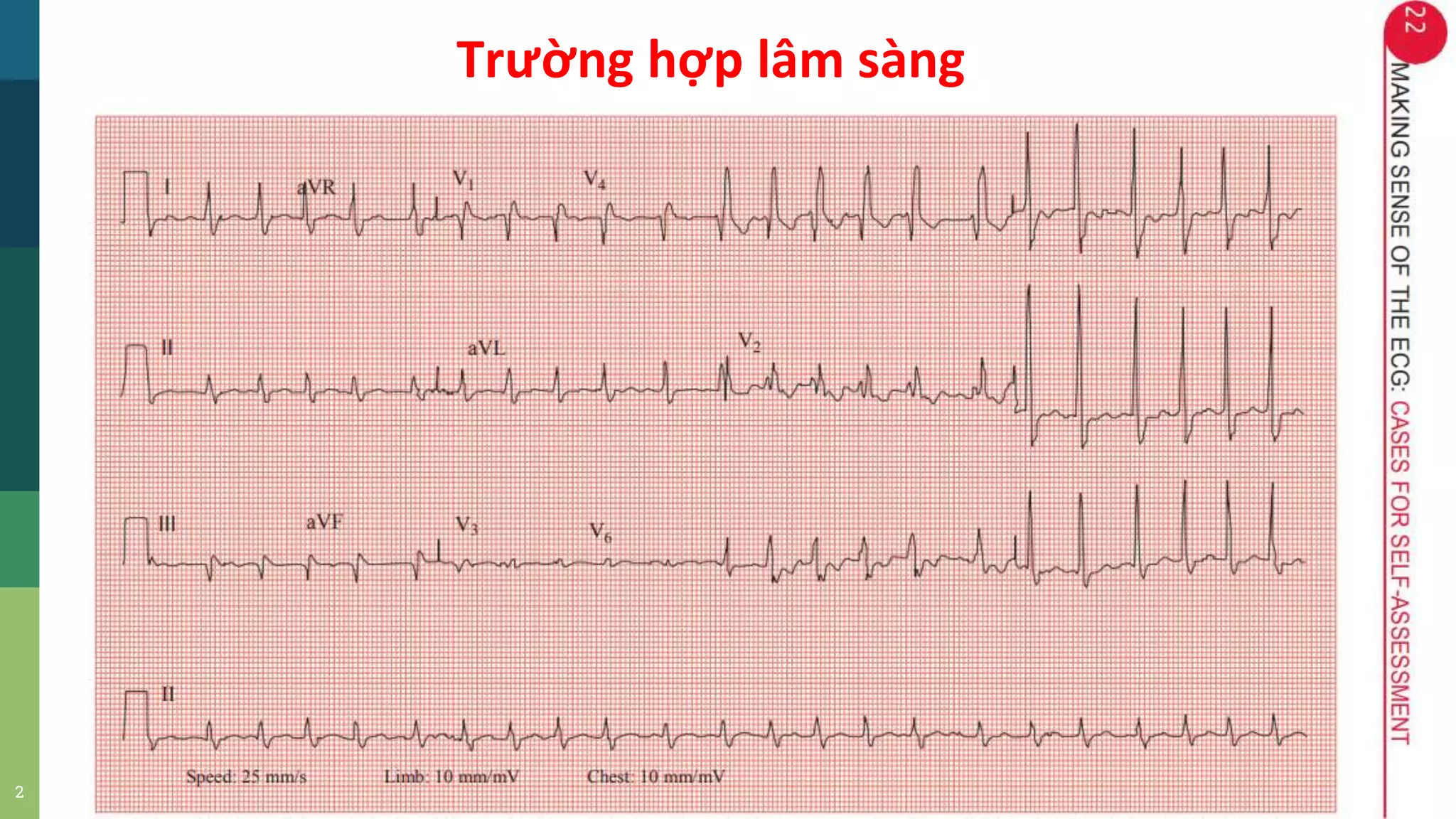 Tiếp Cận Chẩn Đoán Và Điều Trị Rung Nhĩ 2021 | PPTX