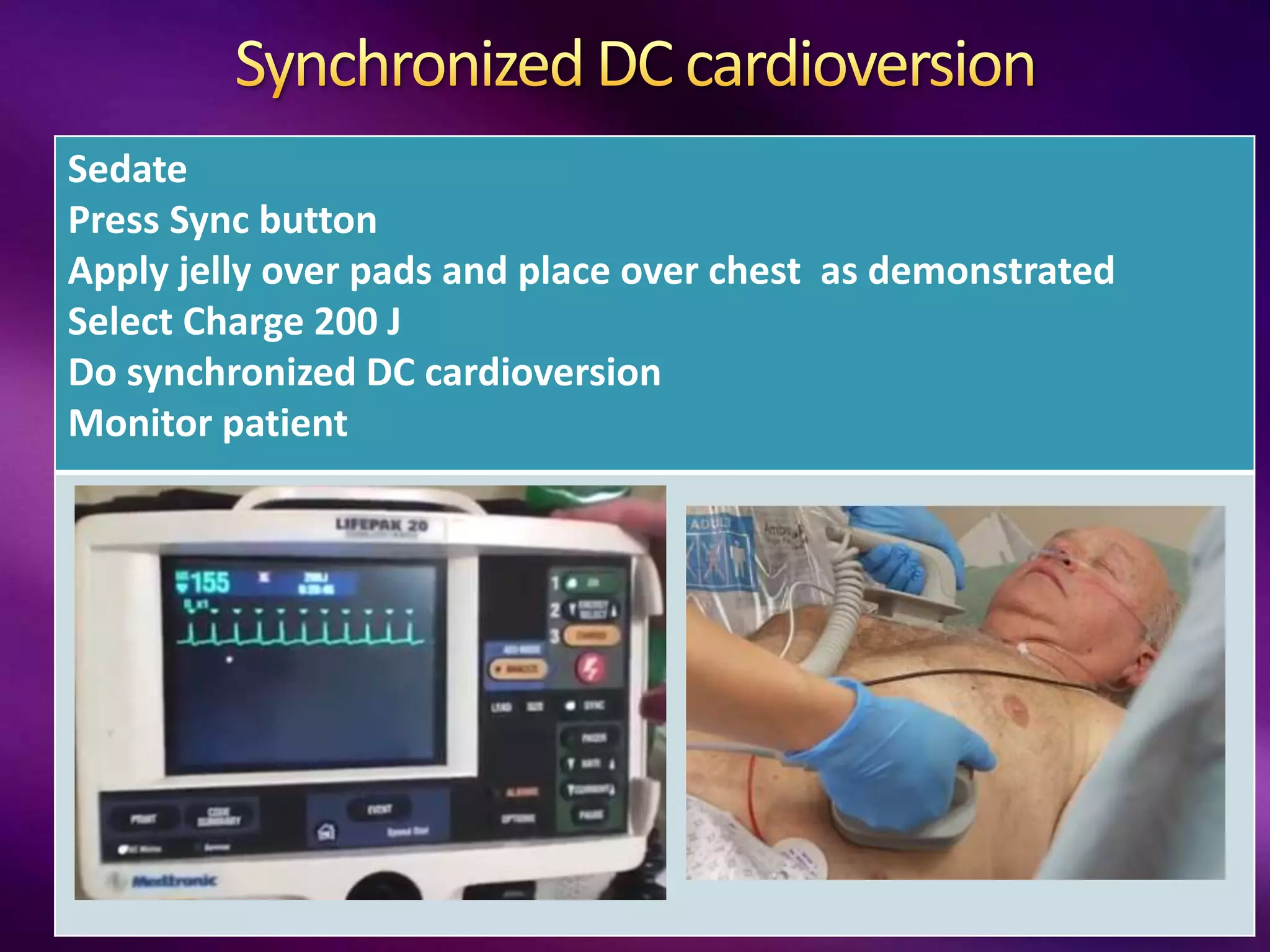 ATRIAL FIBRILLATION | PPTX