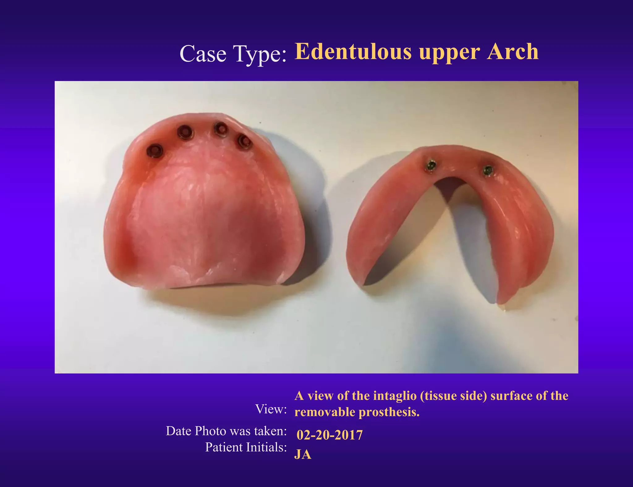 Edentulous arch maxilla photographs | PPTX