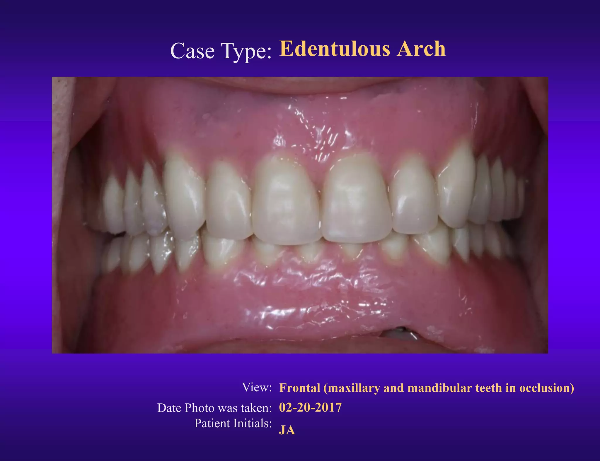Edentulous arch maxilla photographs | PPTX