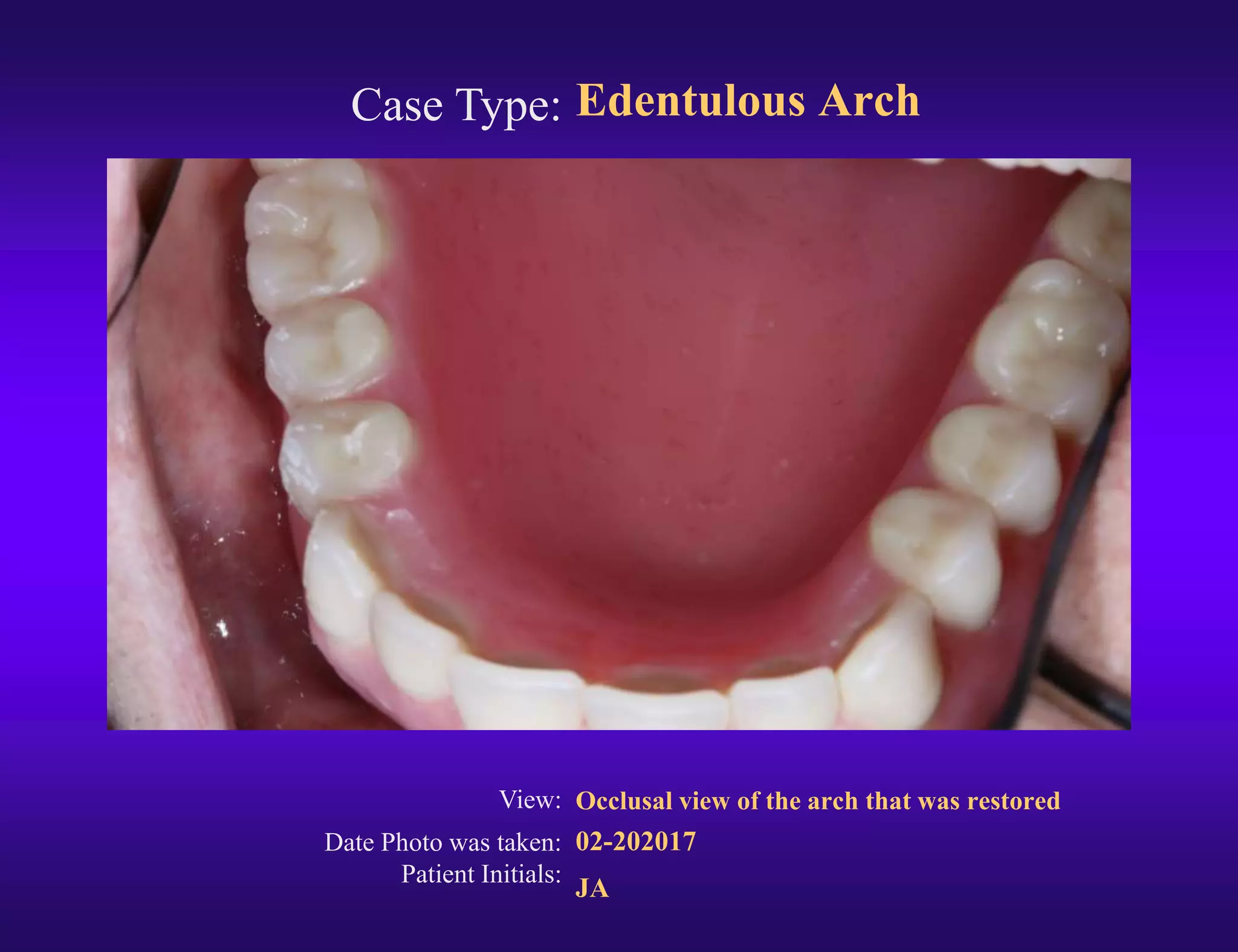 Edentulous arch maxilla photographs | PPTX
