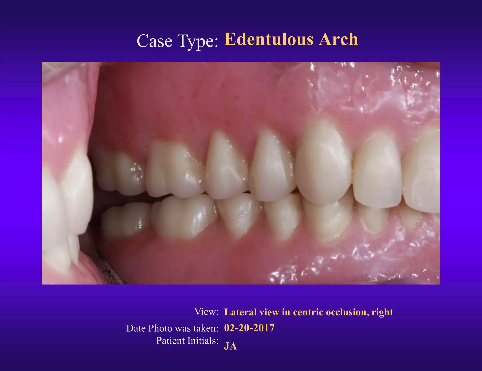 Edentulous arch maxilla photographs | PPT