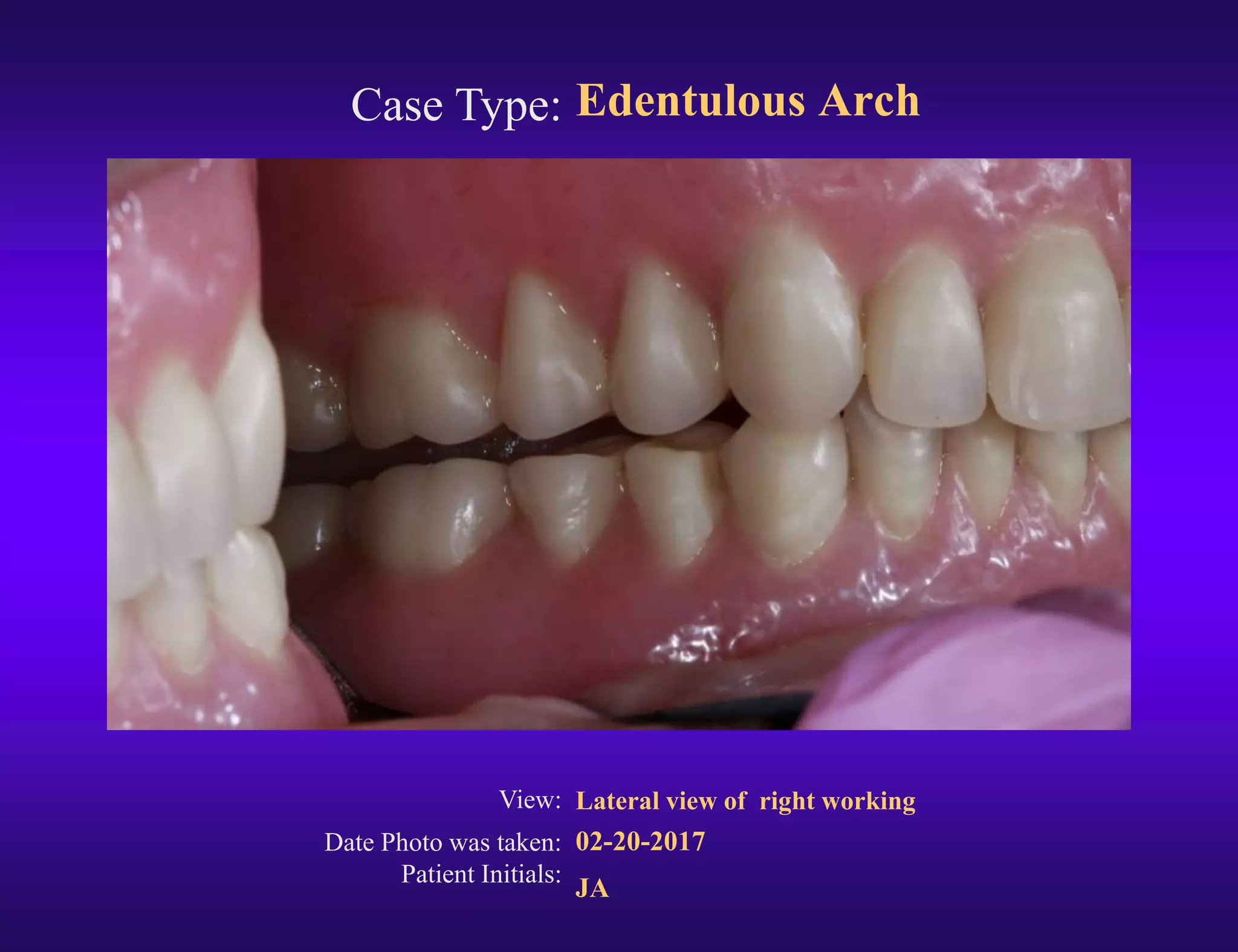 Edentulous arch maxilla photographs | PPTX