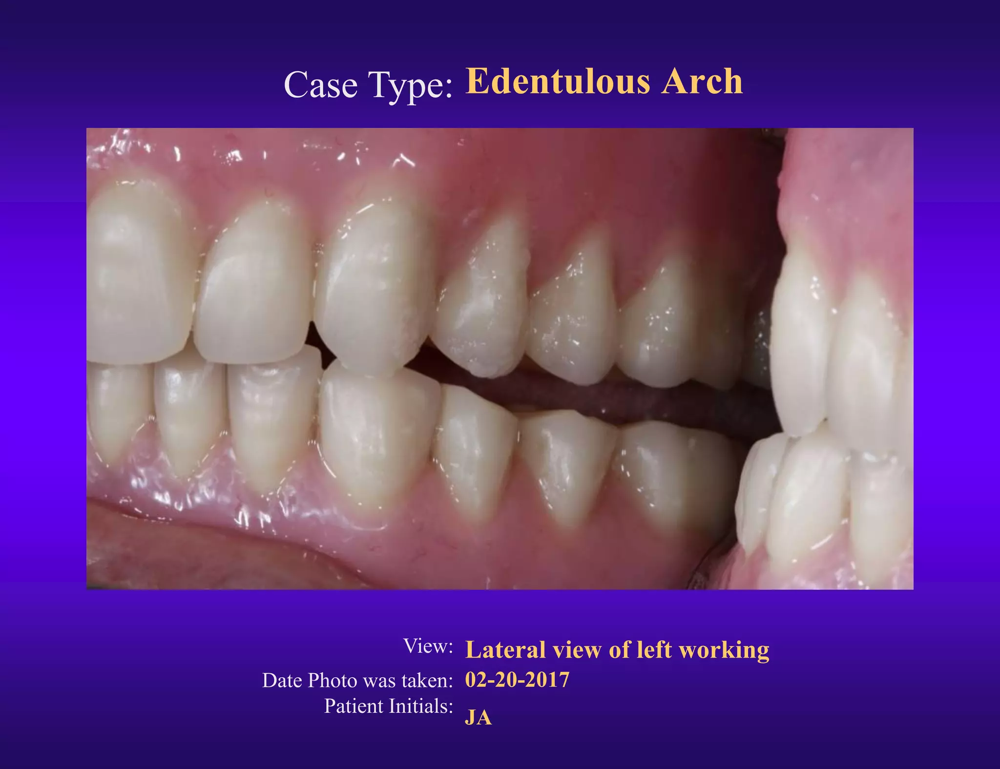 Edentulous arch maxilla photographs | PPT