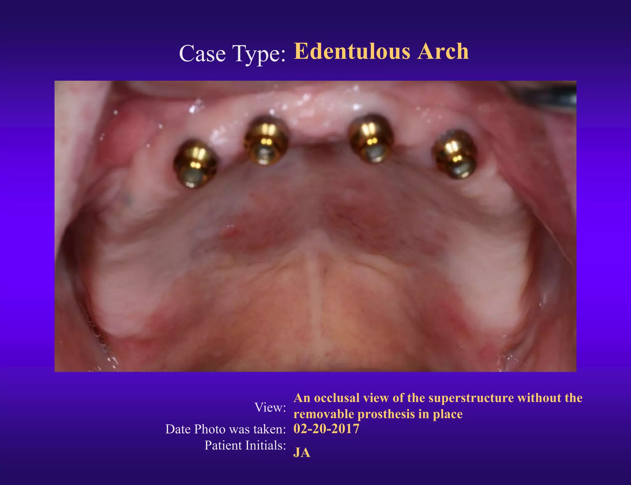 Edentulous arch maxilla photographs | PPTX
