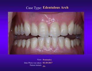 Edentulous arch maxilla photographs | PPTX