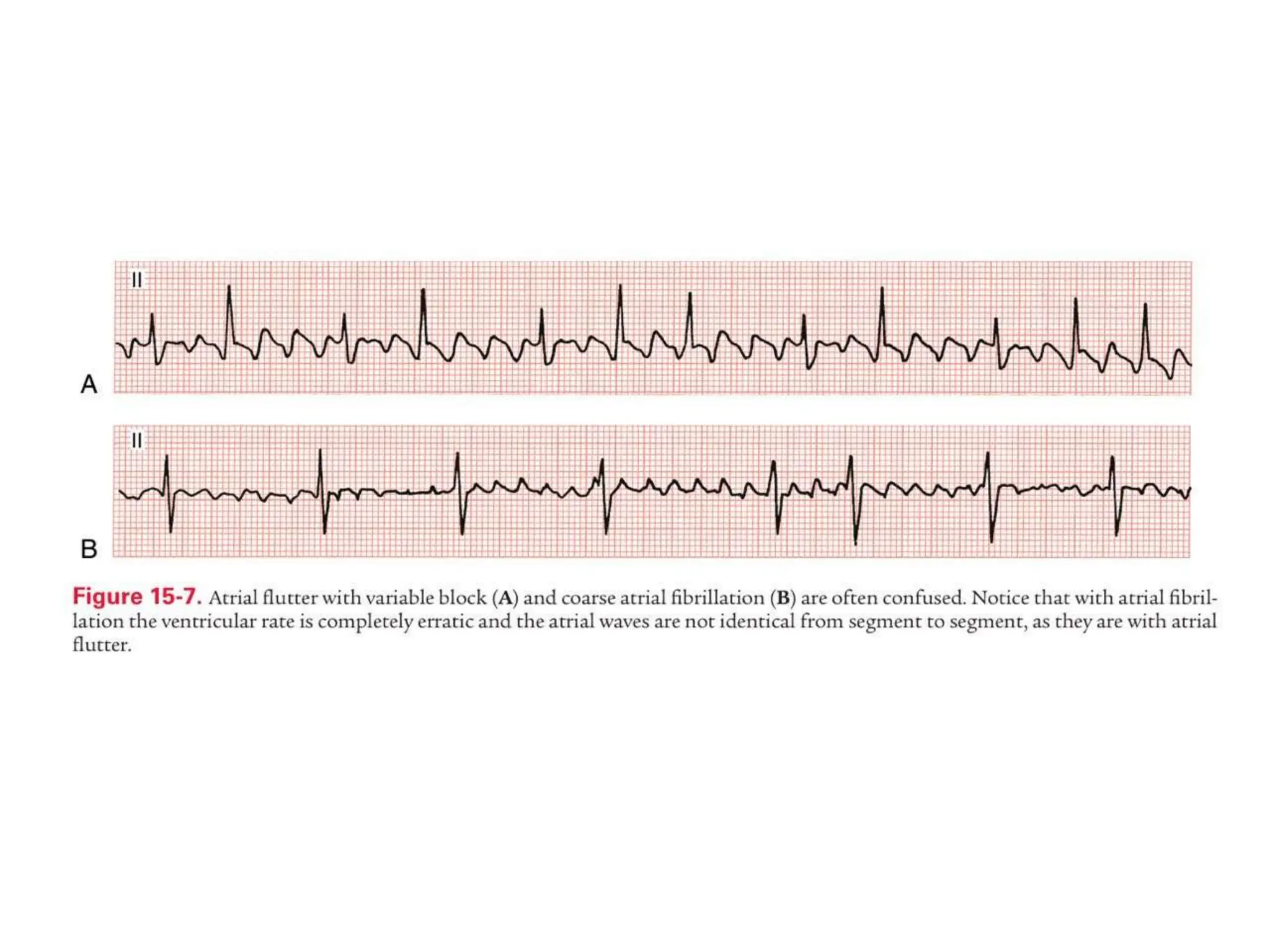 Atrial Fib And Atrial Flutter Pptx