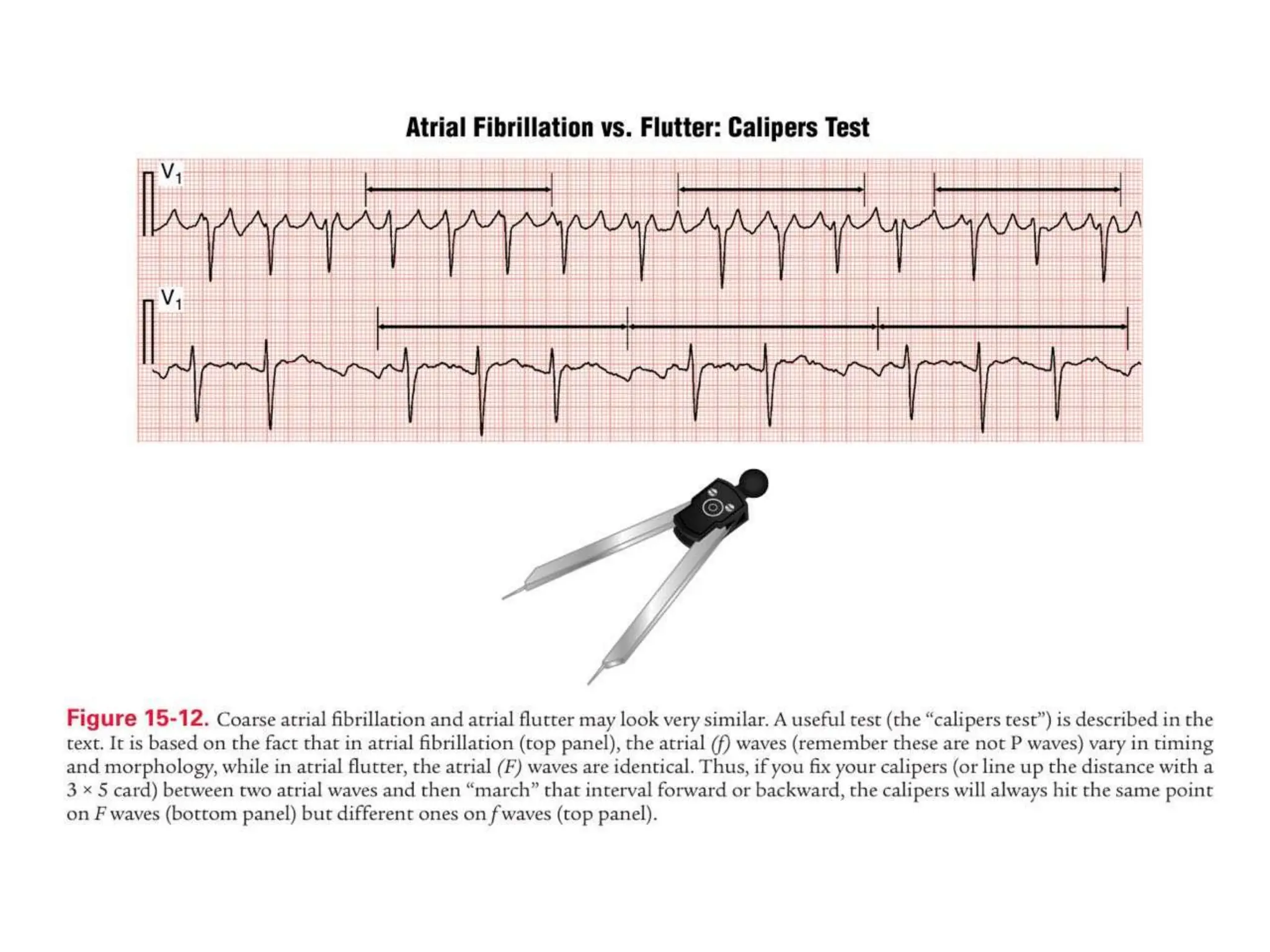 Atrial Fib And Atrial Flutter Pptx