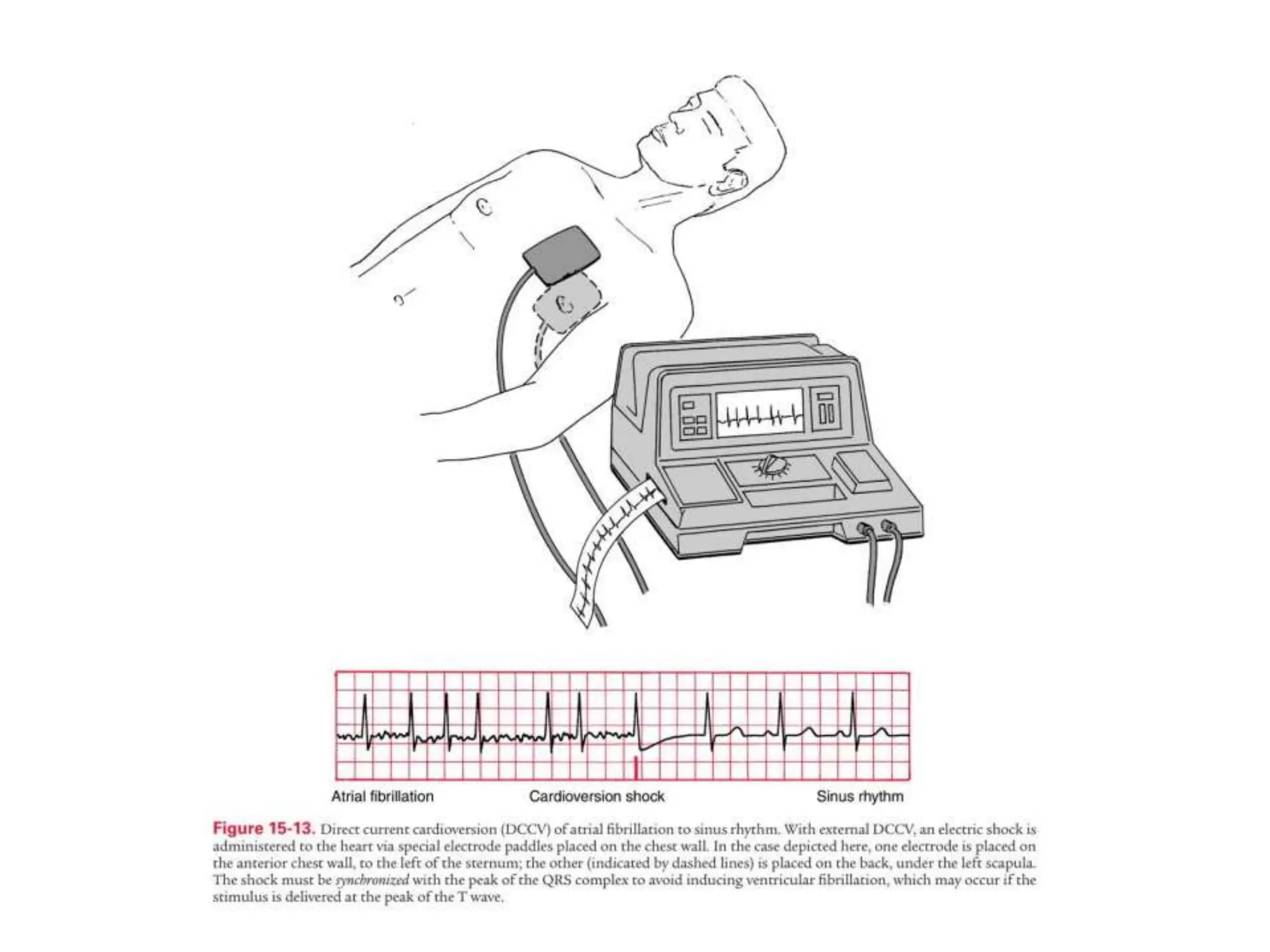 Atrial Fib And Atrial Flutter Pptx