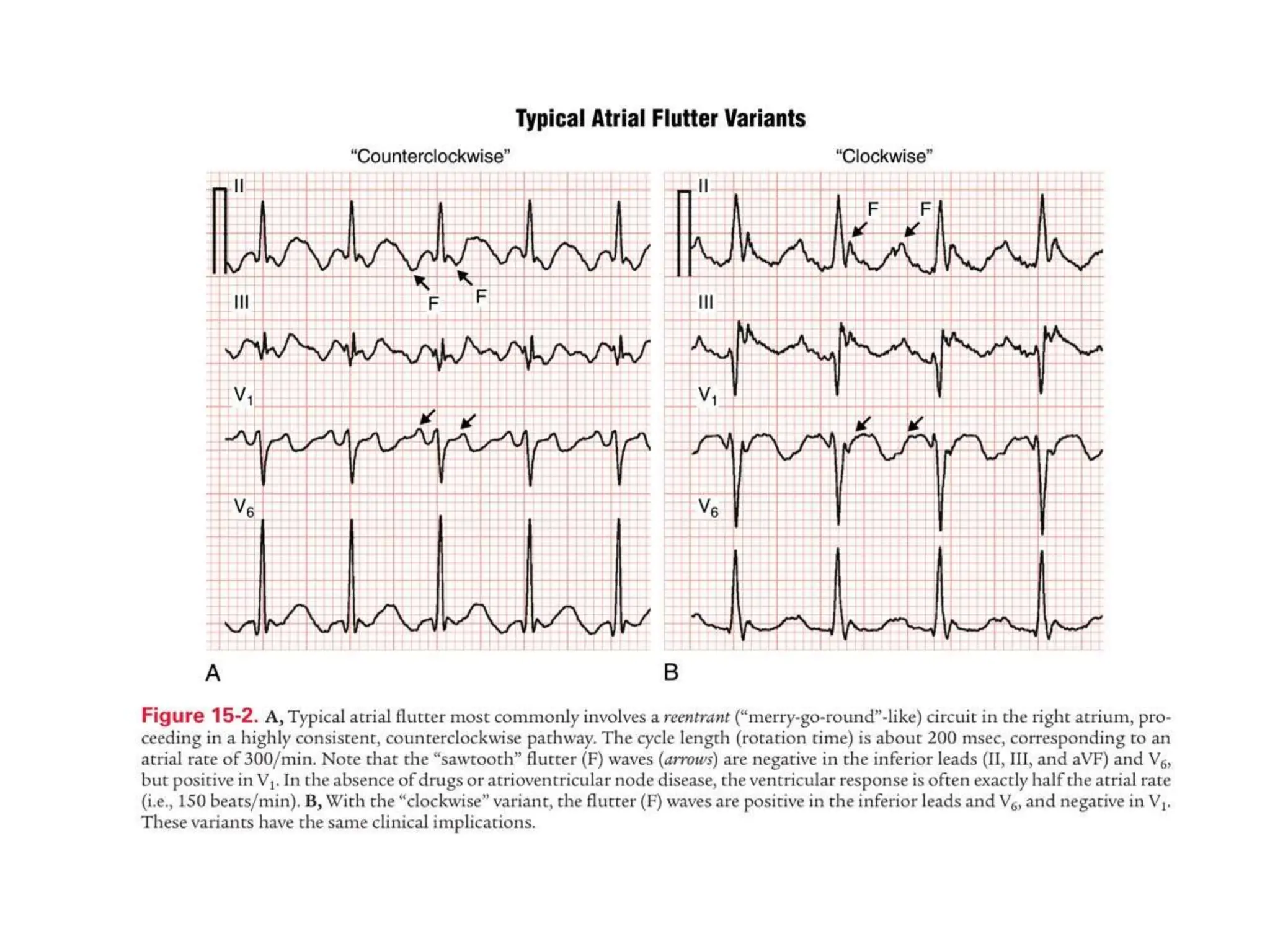 atrial fib and atrial flutter .pptx