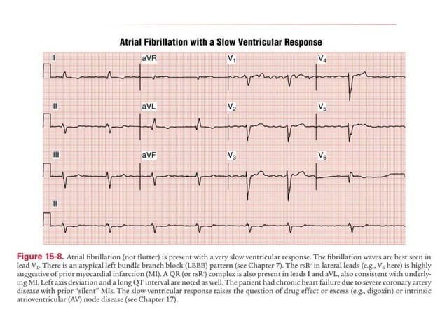 atrial fib and atrial flutter .pptx