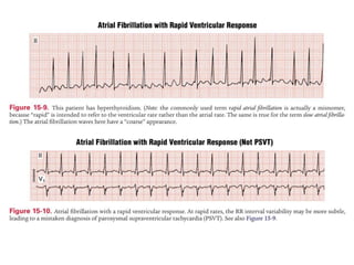 atrial fib and atrial flutter .pptx