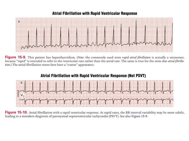 atrial fib and atrial flutter .pptx