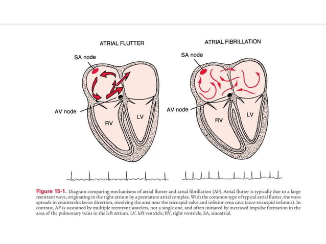 Atrial Fib And Atrial Flutter Pptx