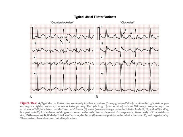 atrial fib and atrial flutter .pptx
