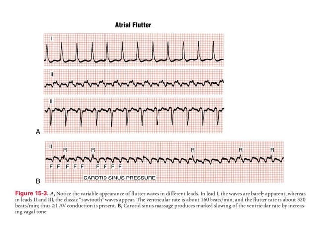 Atrial Fib And Atrial Flutter Pptx
