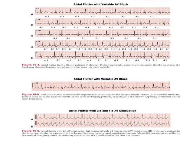 atrial fib and atrial flutter .pptx