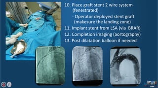 AFCC Implantation of Fenestrated TEVAR-converted.pdf