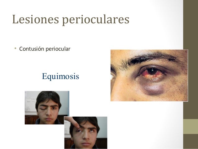 Equimosis Bucal