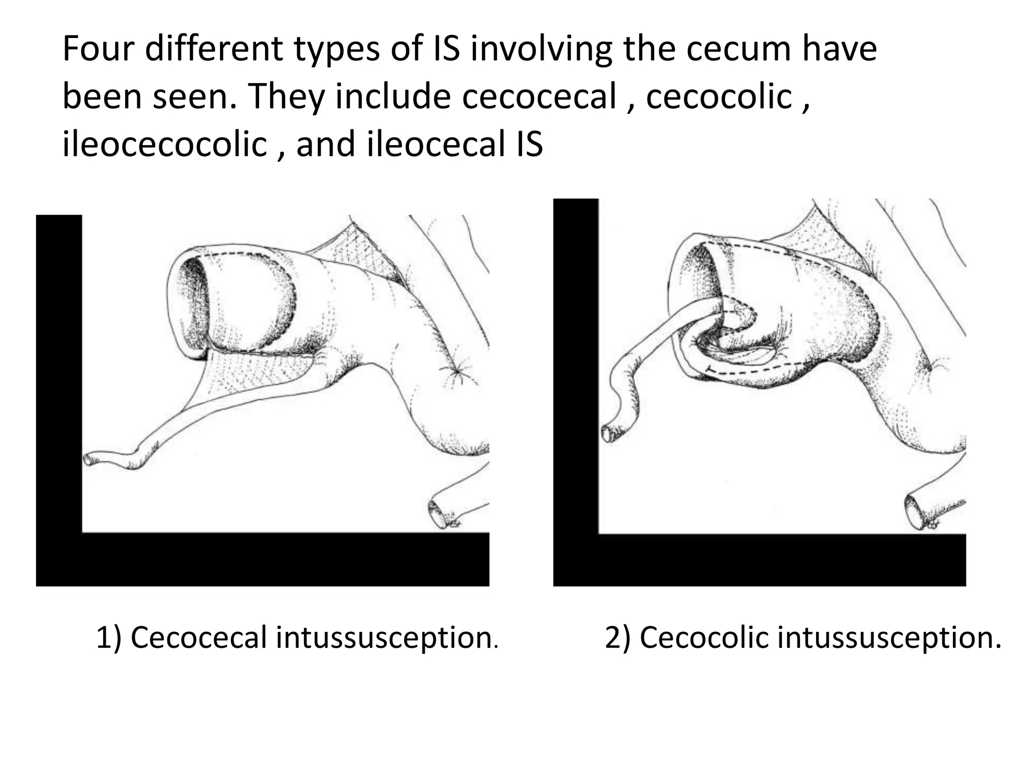 Affections of cecum, colon & rectum (Veterinary) | PPTX