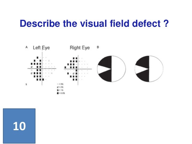 Afferent visual pathway