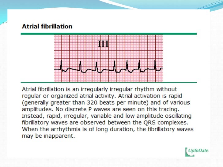 La Fibrillation Auriculaire (French) Symposia - The CRUDEM Foundation