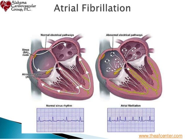 Atrial Fibrillation - From Diagnosis to Treatment - St Vincent's Birm…