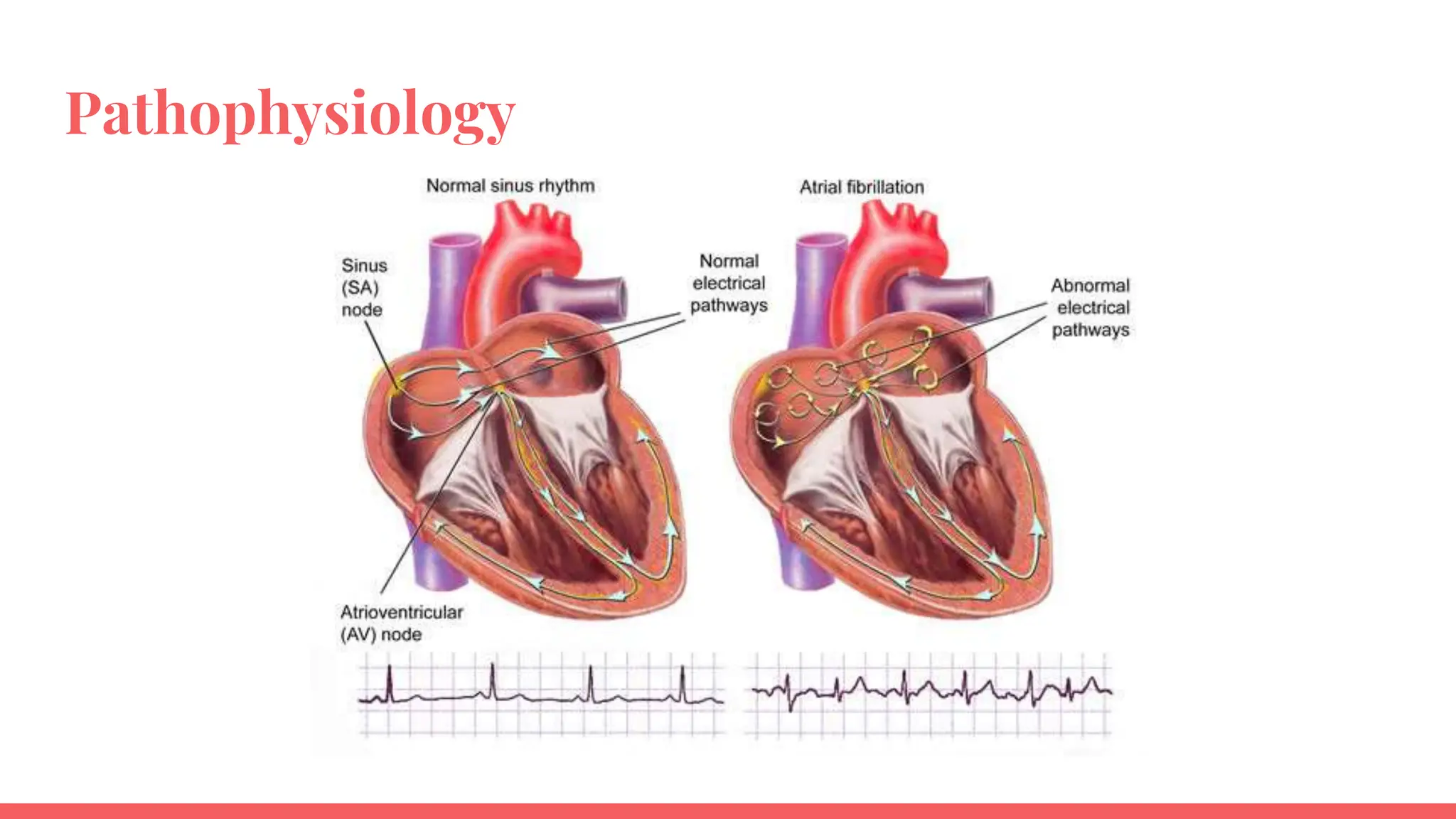 atrial fibrillation guidelines presentation | PPTX