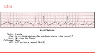 atrial fibrillation guidelines presentation | PPTX