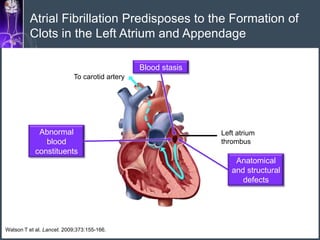 Defining Moments in Non-Valvular Atrial Fibrillation: Pathophysiology ...