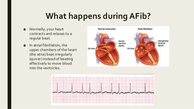 Understanding Atrial Fibrillation understanding-atrial-fibrillation