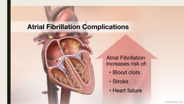 Understanding Atrial Fibrillation