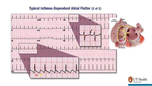 Afib lecture.pptx Atrial fibrillation is | PPTX