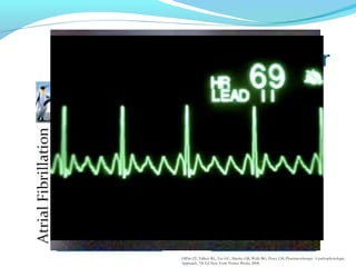 Atrial Fibrillation/Flutter Presentation | PPT