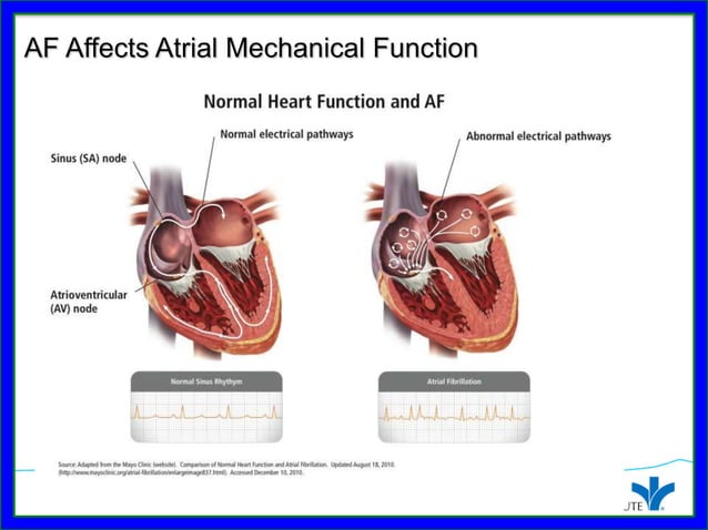 A fib treatment strategies | PPTX