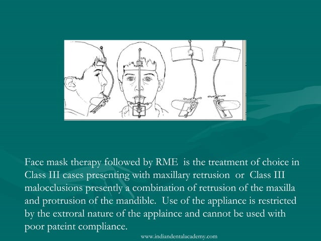 A fixed reverse labial bow for moderate class 3