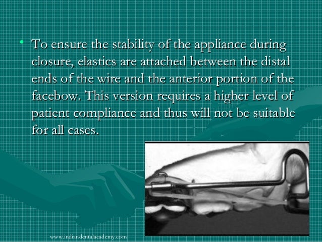 A fixed reverse labial bow for moderate class 3