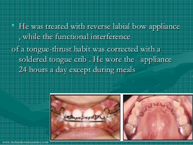 A fixed reverse labial bow for moderate class 3