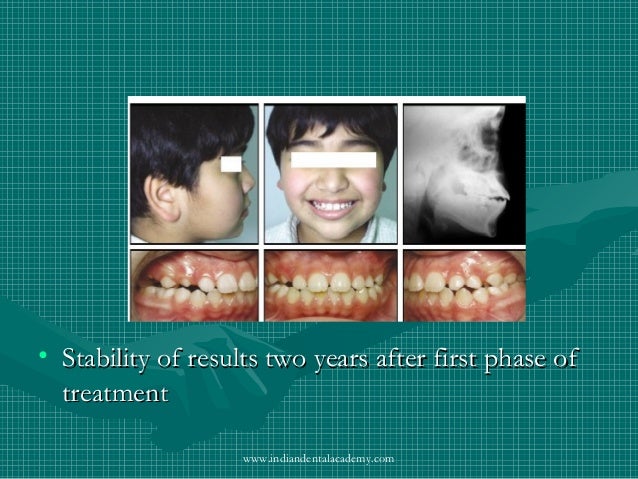 A fixed reverse labial bow for moderate class 3