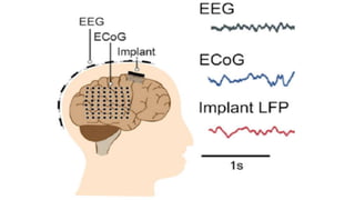 ELECTROCORTICOGRAPHY(ECOG) | PPTX